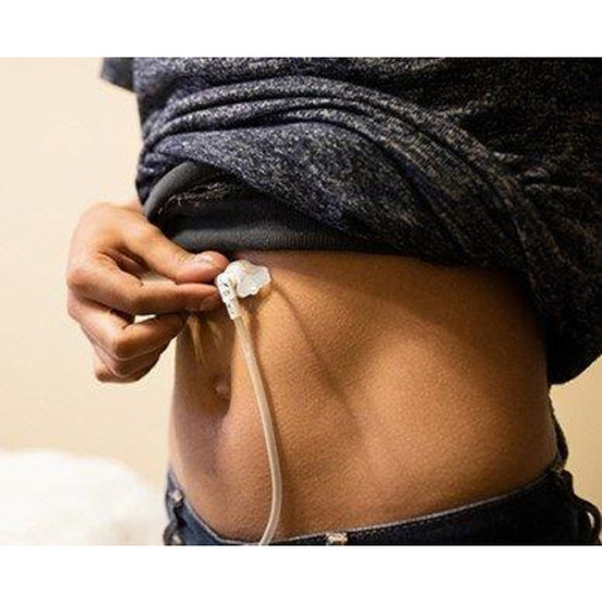 PEG Awareness - Training 2 Care UK Ltd